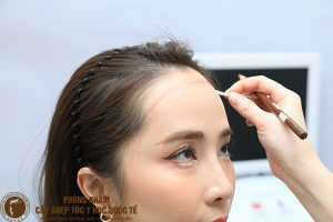 Theo chân diễn viên Quỳnh Nga cấy tóc tại Phòng khám Cấy tóc Quốc tế