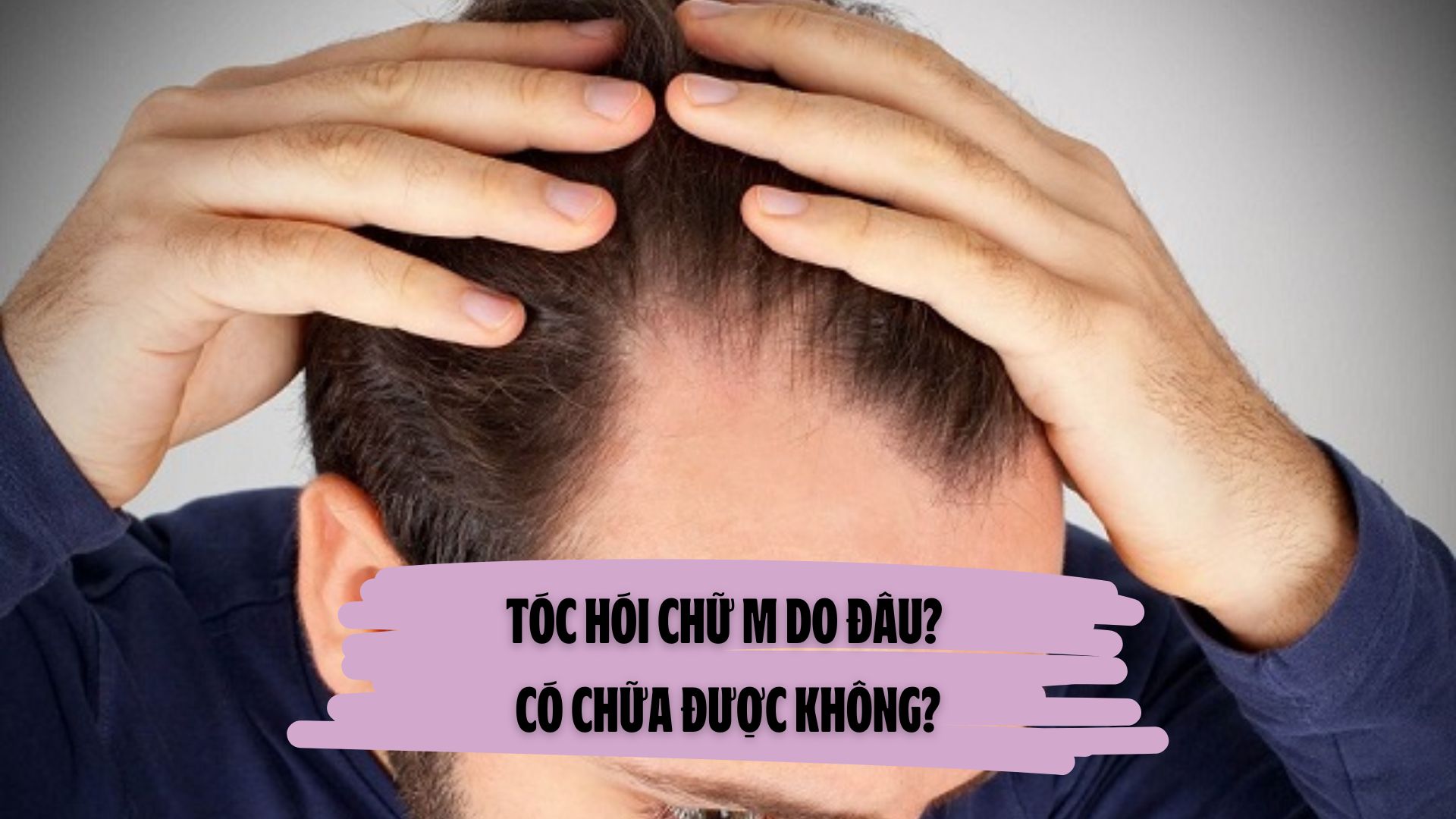 [Giải đáp] Tóc hói chữ M do đâu? Có chữa được không?