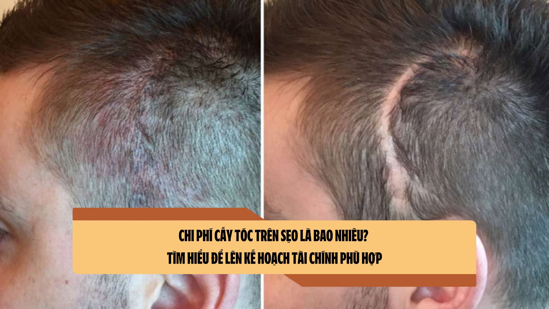 Chi phí cấy tóc trên sẹo là bao nhiêu? Tìm hiểu để lên kế hoạch tài chính phù hợp