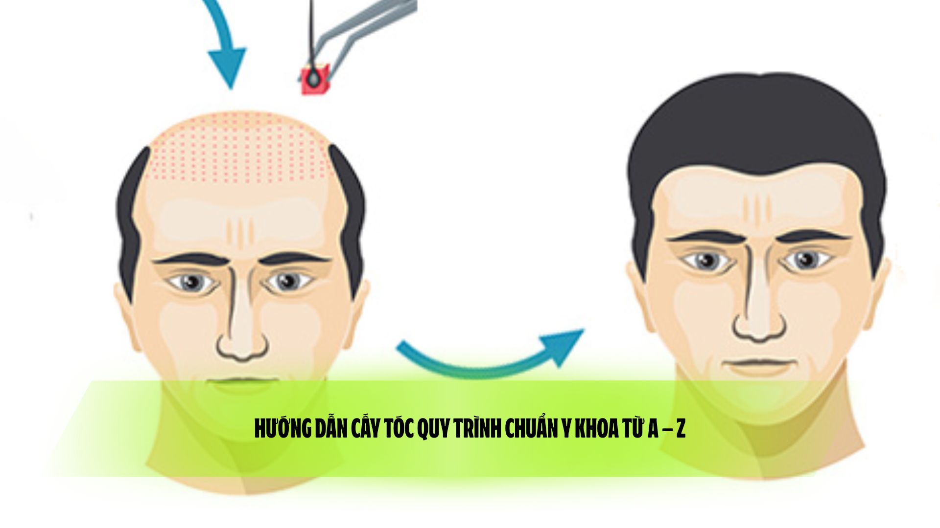 Hướng dẫn cấy tóc quy trình chuẩn y khoa từ A – Z